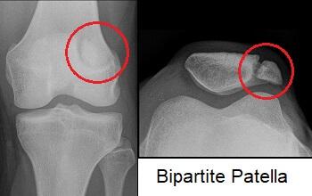 Bipartite Patella in Children - ArthurCare