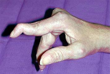 Swan Neck Deformity of the Finger - ArthurCare