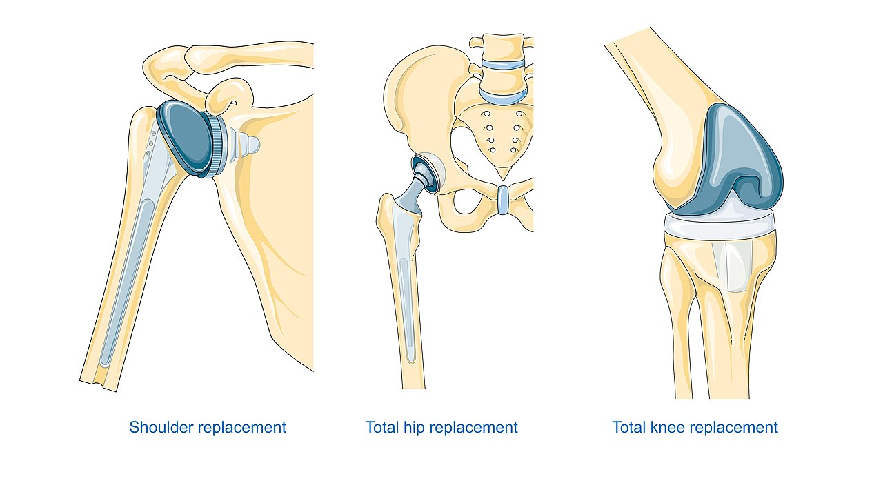 Artificial Joint Replacement of the Shoulder - ArthurCare