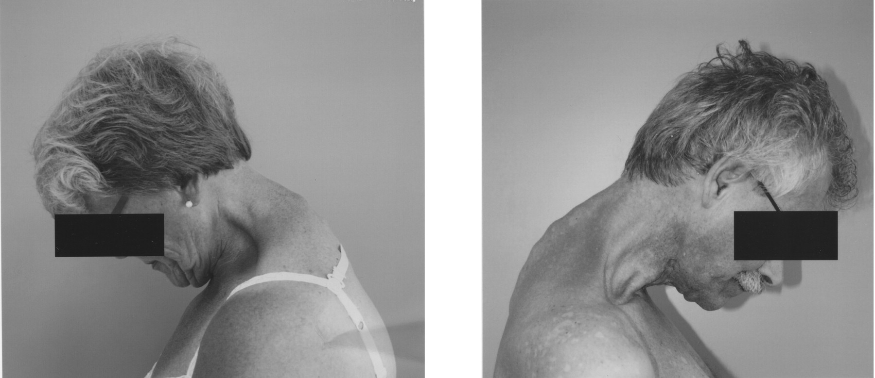 Dropped Head Syndrome - ArthurCare