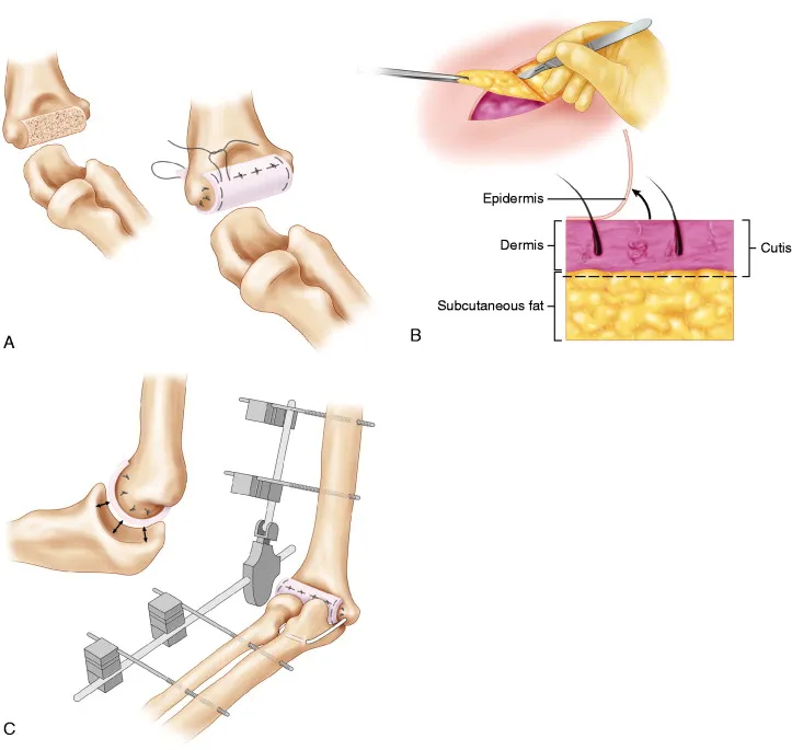 Interposition Elbow Arthroplasty - ArthurCare