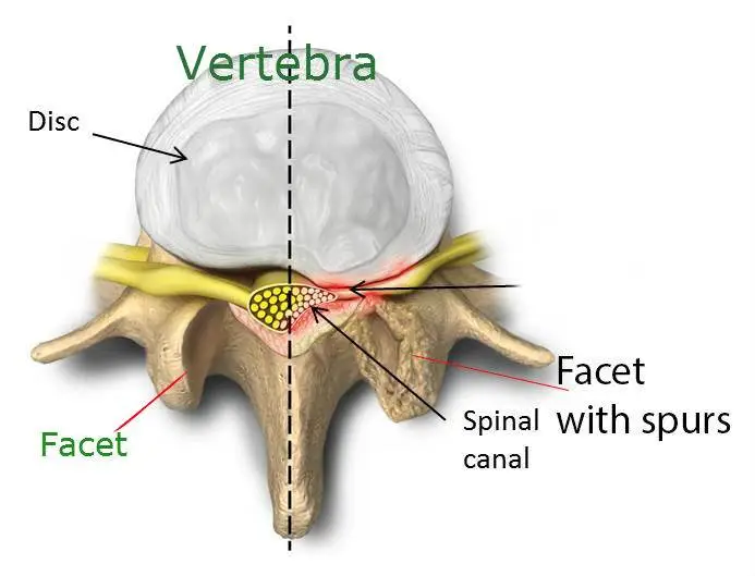 Lumbar Facet Joint Arthritis - ArthurCare
