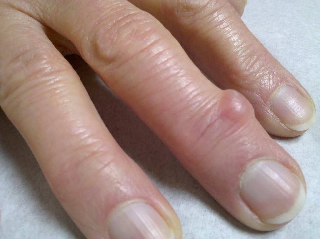 Mucous Cysts Of The Fingers Arthurcare 1990