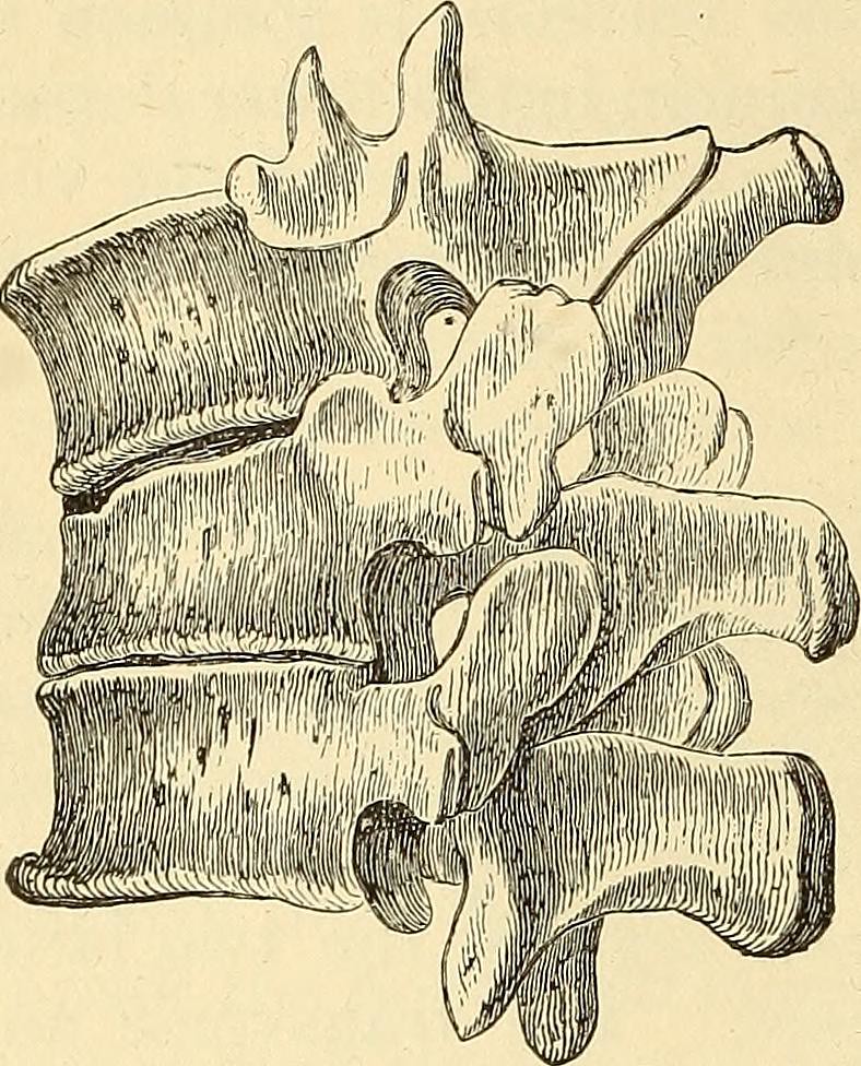 Spinal Compression Fractures - ArthurCare