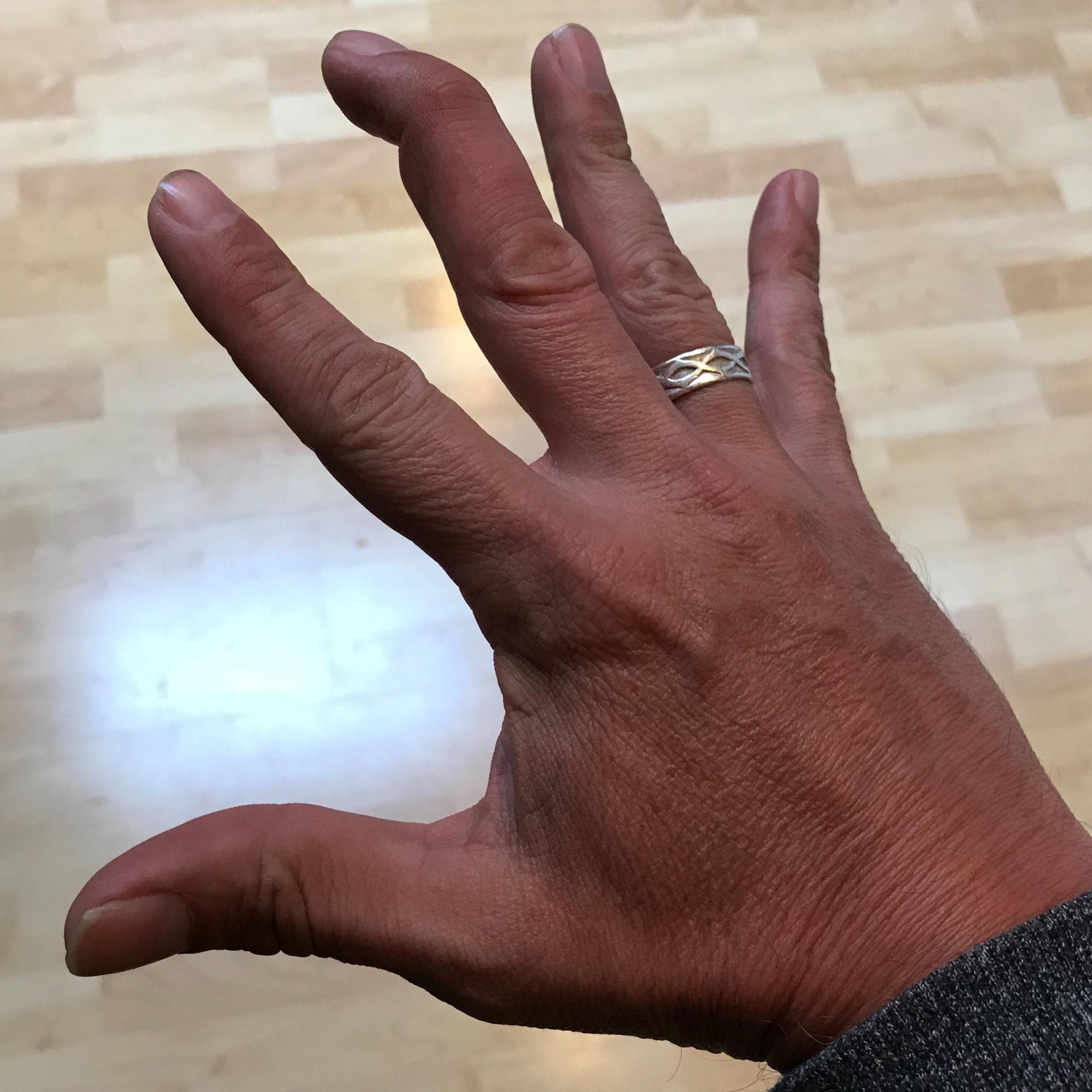 Mallet Finger Injuries - ArthurCare