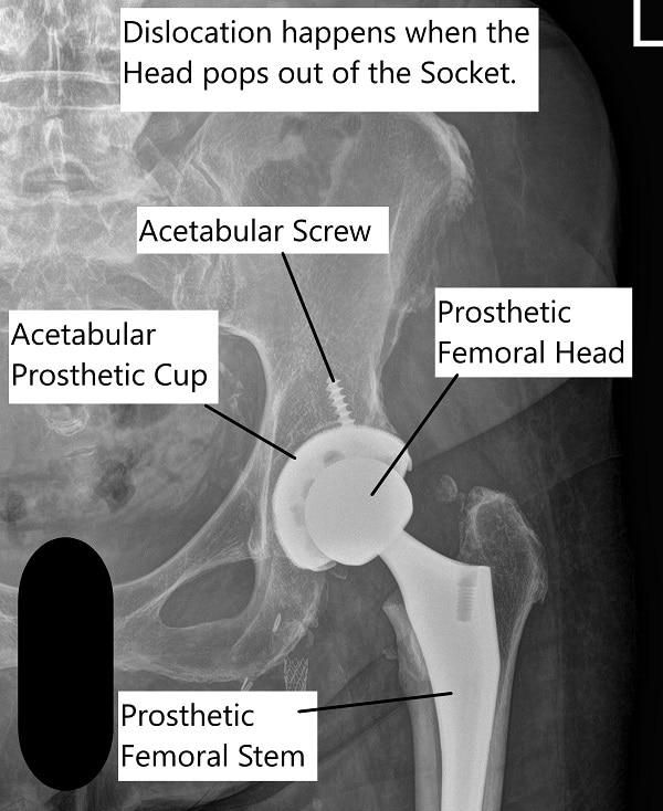 Artificial Hip Dislocation Precautions - ArthurCare