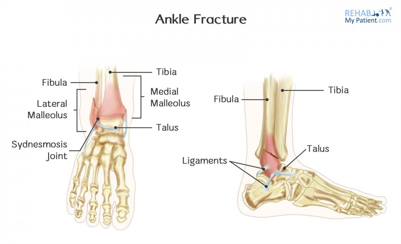 Ankle Fractures Arthurcare