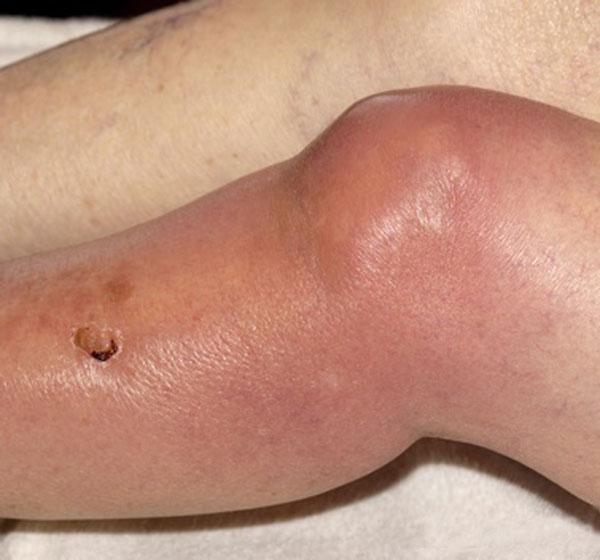 Septic Arthritis of the Hip in Children - ArthurCare