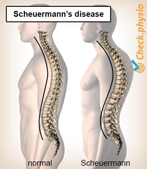 Scheuermann’s Disease - ArthurCare