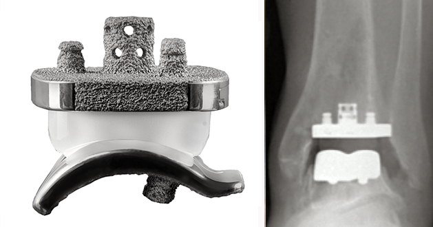 Ankle Replacement - ArthurCare