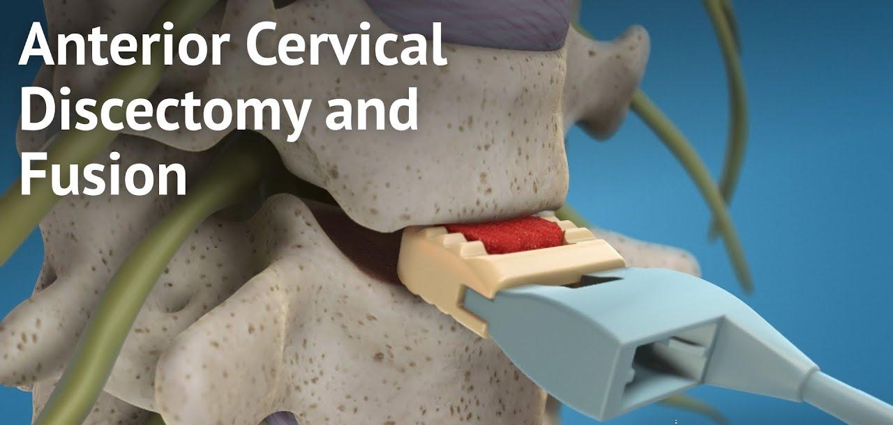 Anterior Cervical Discectomy and Fusion - ArthurCare
