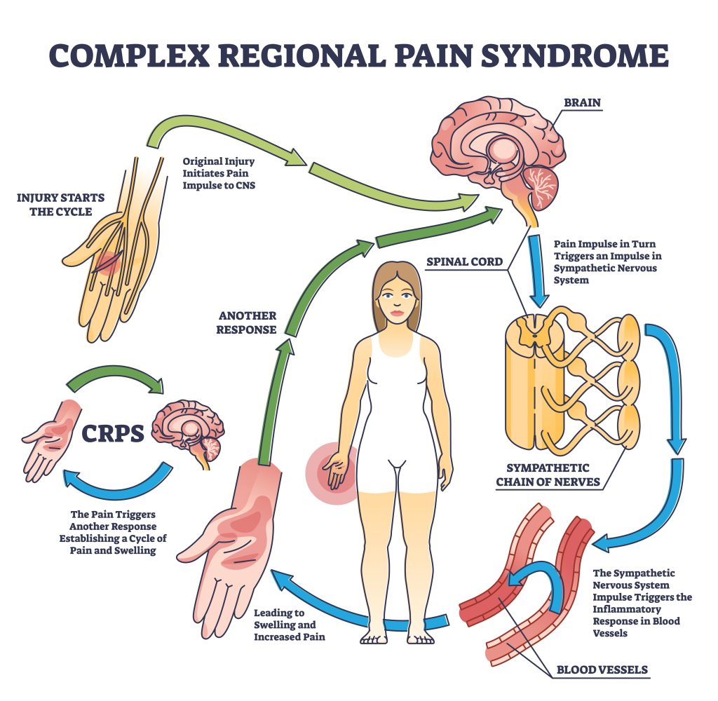 Complex Regional Pain Syndrome - ArthurCare