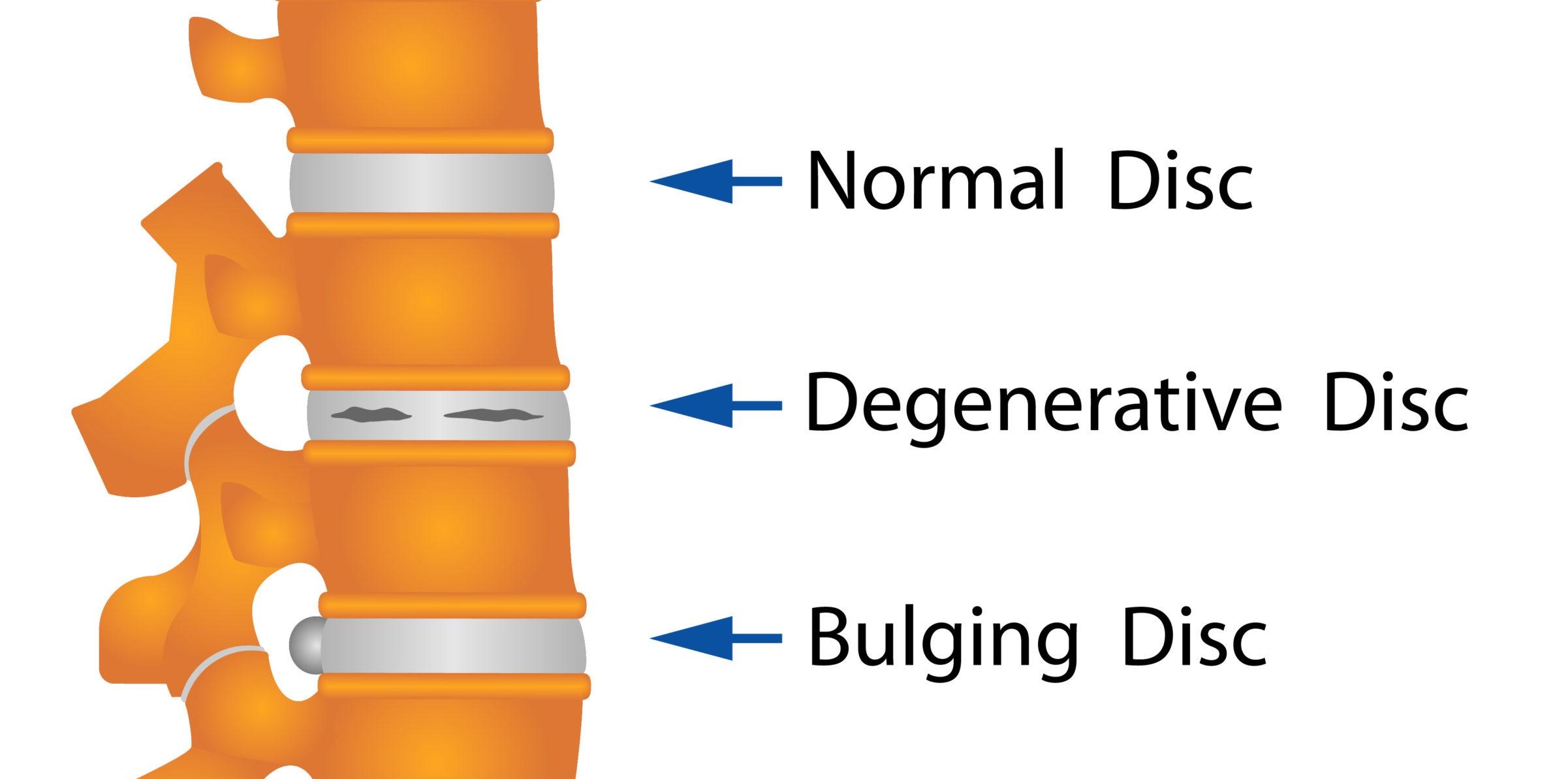 Degenerative Disc Disease - ArthurCare