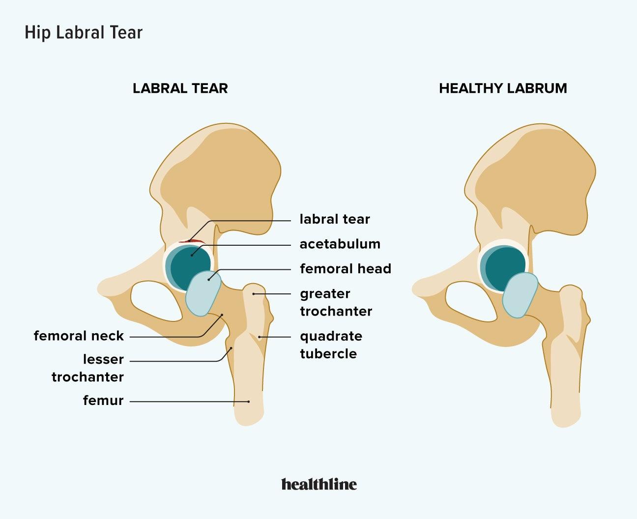Labral Tears - ArthurCare