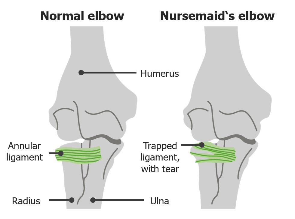 Nursemaid’s Elbow - ArthurCare