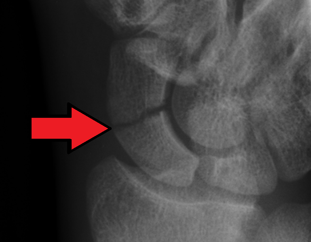 Scaphoid Fracture of the Wrist - ArthurCare