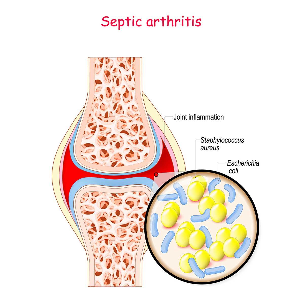 septic-arthritis-arthurcare