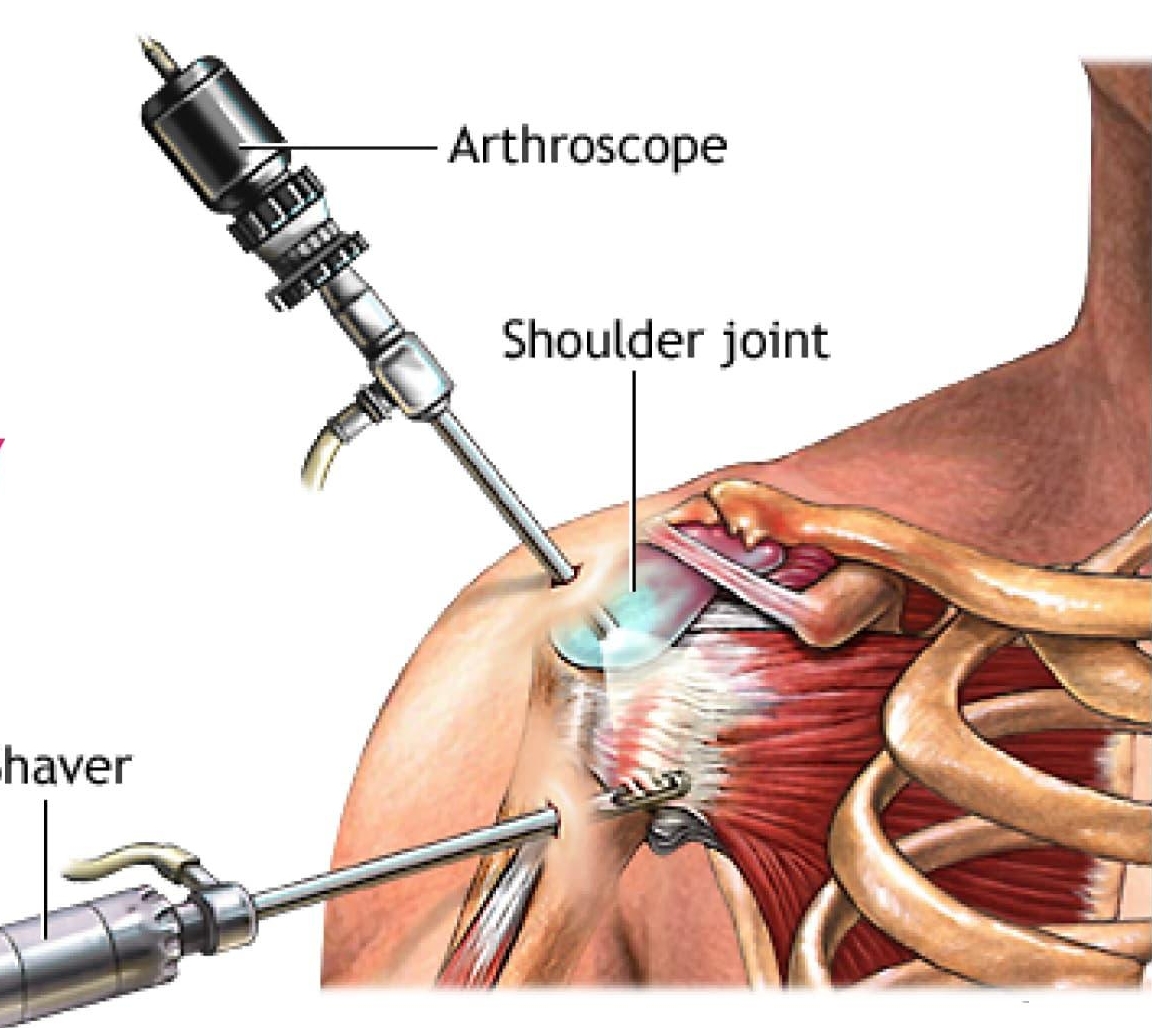 Shoulder Arthroscopy - ArthurCare