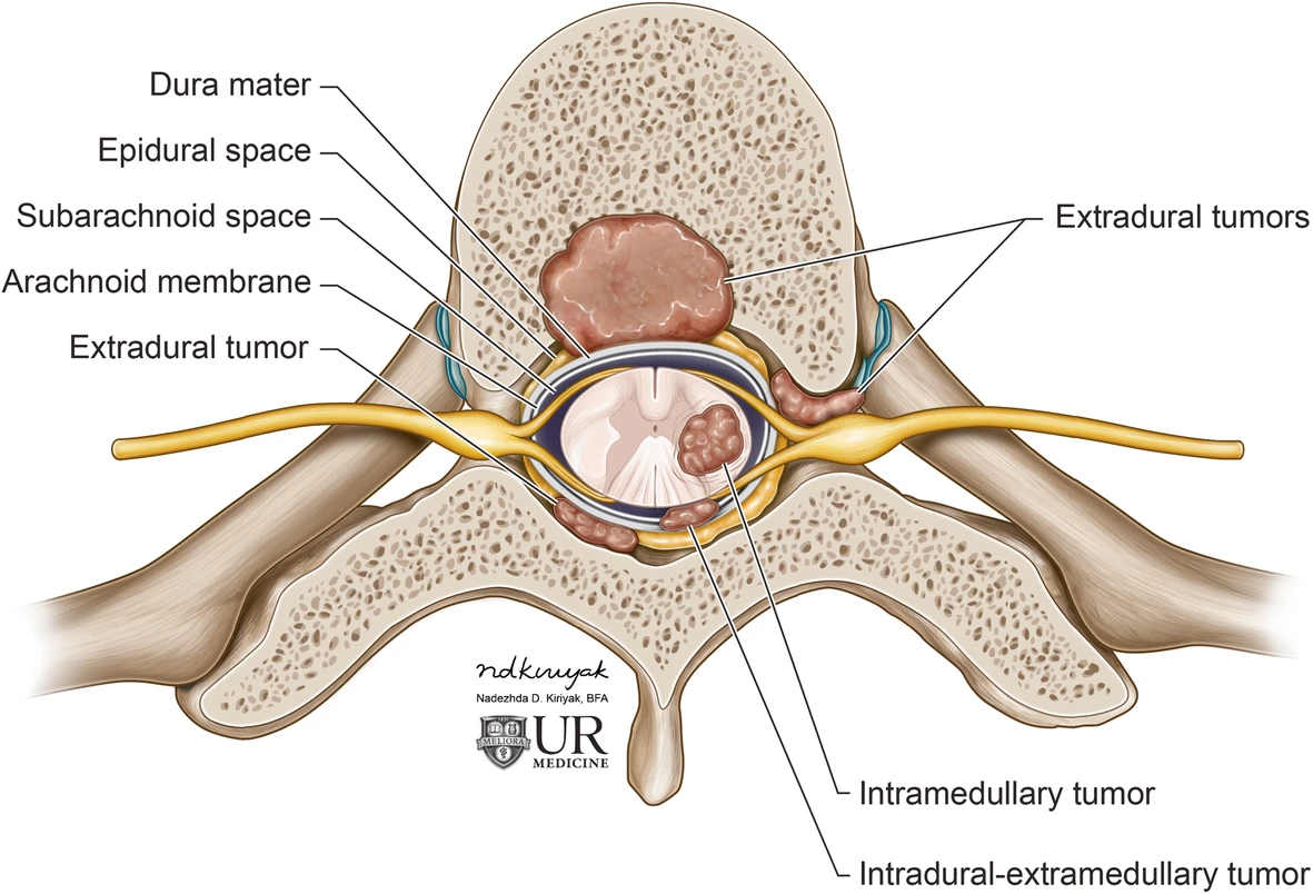 Spinal Tumors ArthurCare spinal-tumors-arthurcare