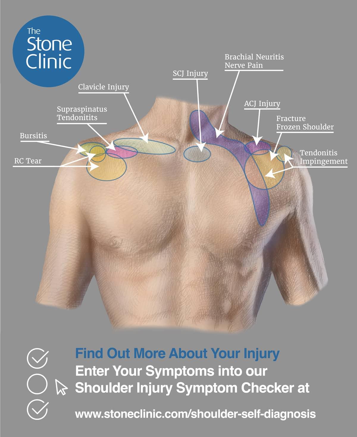 5 Unexpected Triggers of Shoulder Pain and Their Solutions - ArthurCare
